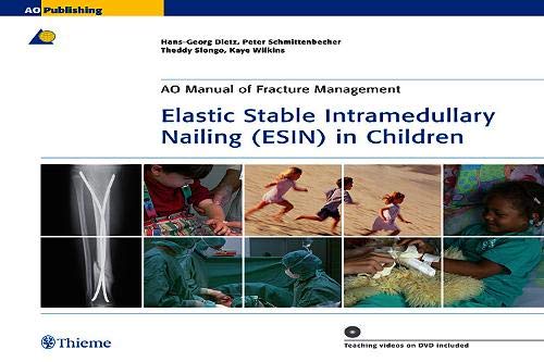 Amazon | Elastic Stable Intramedullary Nailing Esin in Children (Ao-publishing) | Dietz, Hans ...